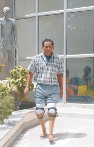Free Artificial Limbs | Jaipur Foot: Prosthetic Limbs