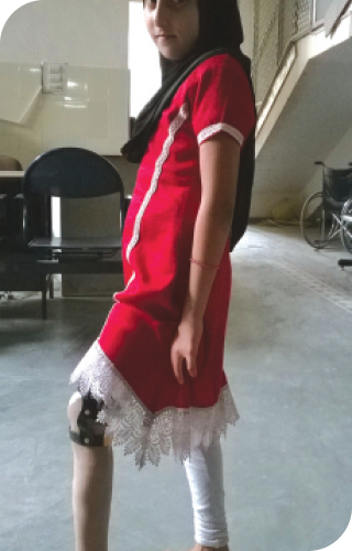 Free Artificial Limbs | Jaipur Foot: Prosthetic Limbs