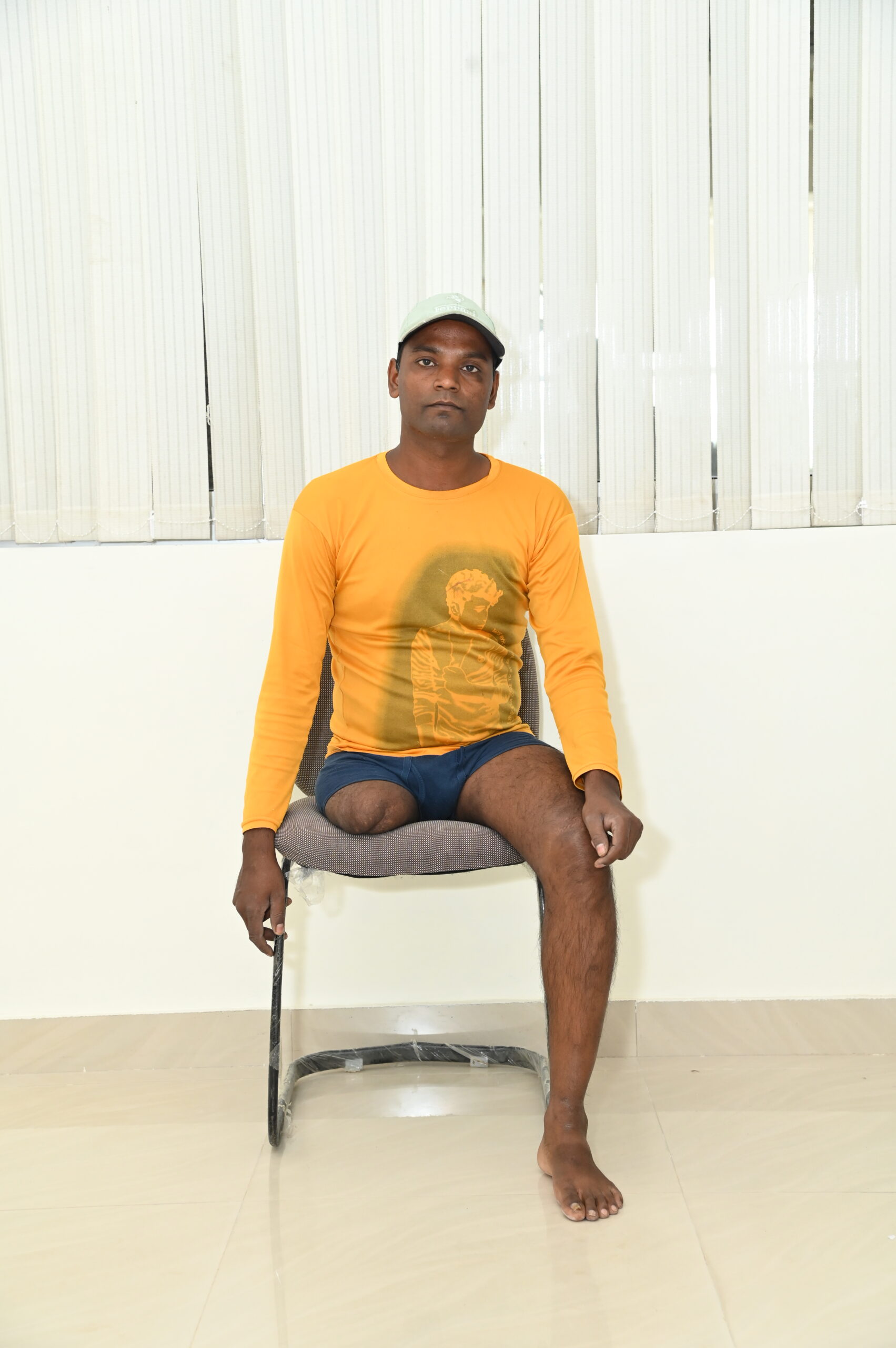Below & Above Knee Prosthesis - Jaipurfoot