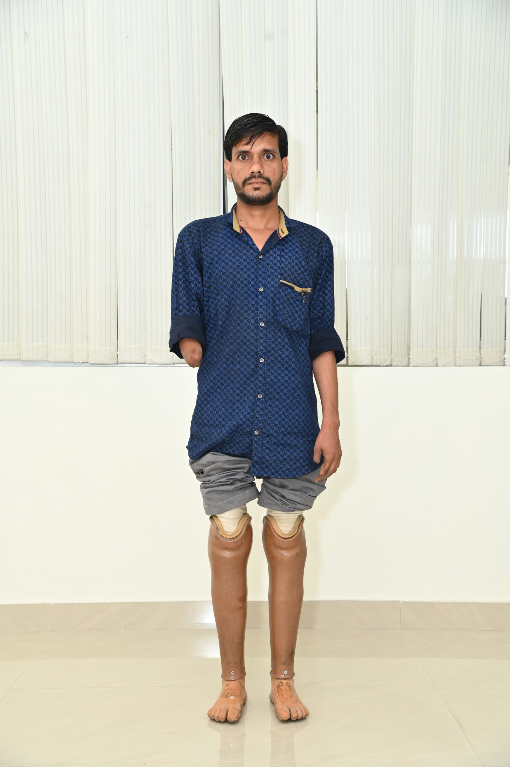 Below & Above Knee Prosthesis - Jaipurfoot