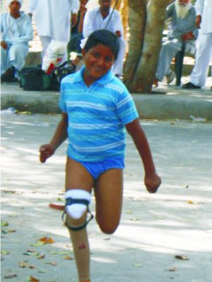 Innovative Technology | Jaipur Foot | BMVSS